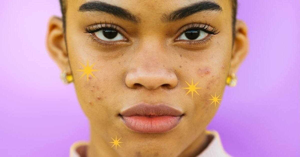 Is my skin purging or breaking out? Here's how to tell.