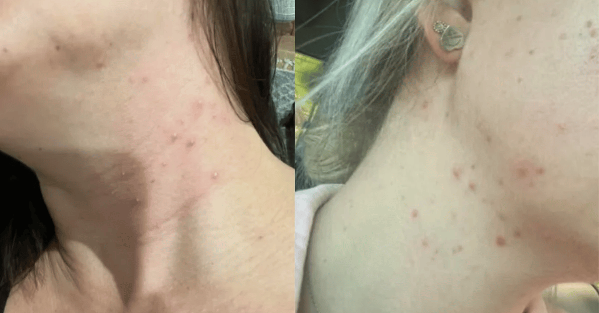 What causes neck pimples and how do you get rid of them?